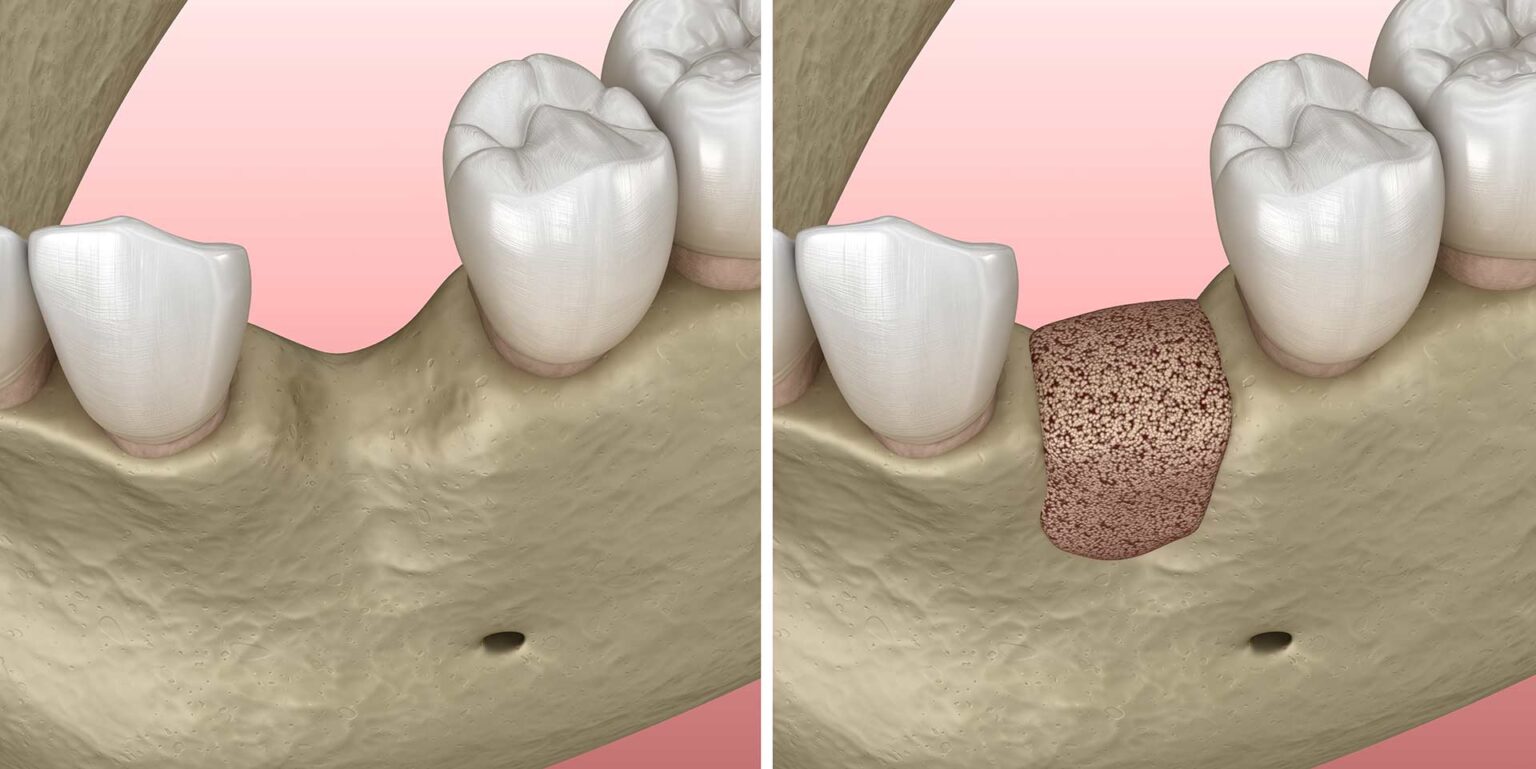 Bone & Soft Tissue Grafting - Dental Implant Center of PA